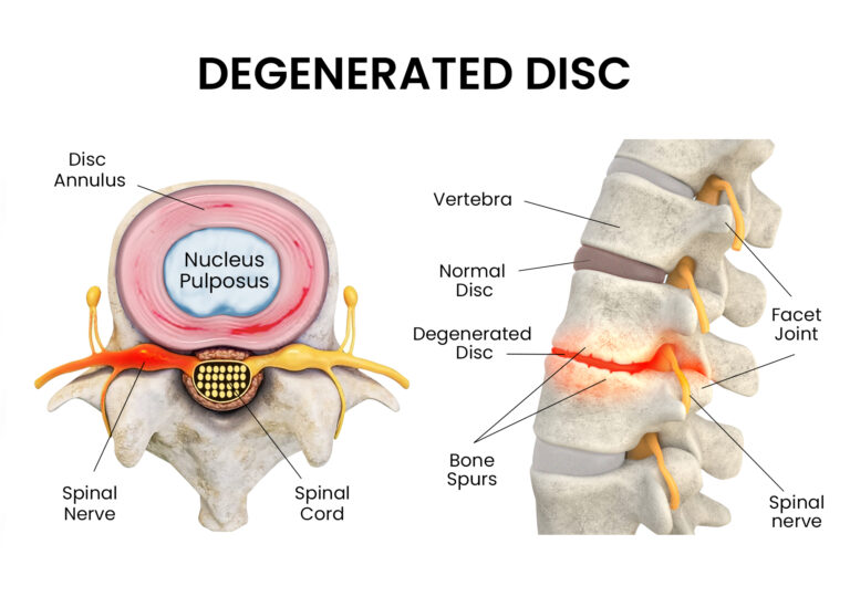 The Discseel Procedure: A Breakthrough Nonsurgical Treatment for ...