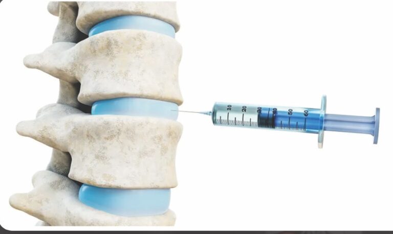 Discseel Procedure: Non-Surgical Chronic Back Pain Relief