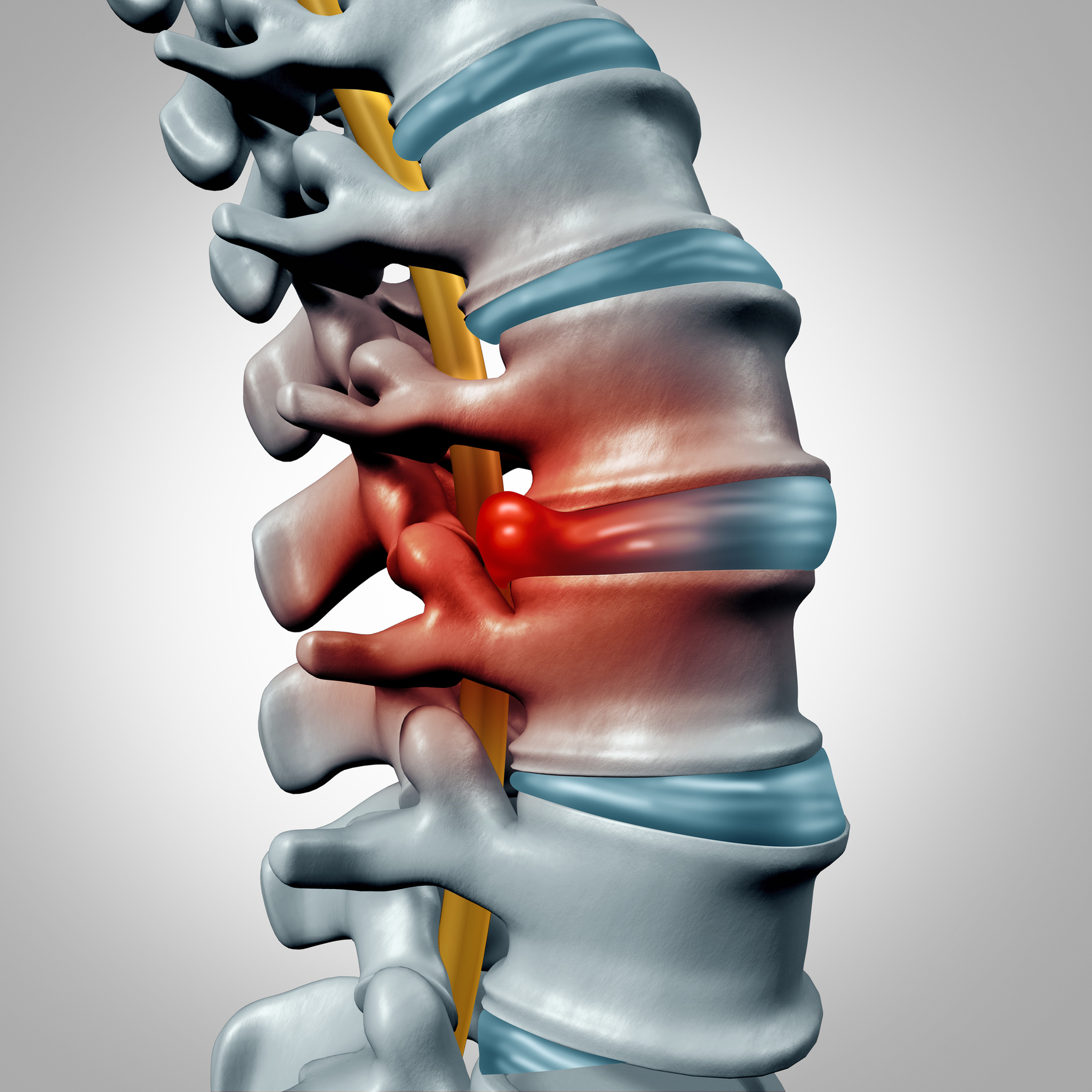 Herniated Lumbar Discs – Causes, Symptoms & Treatment Options ...