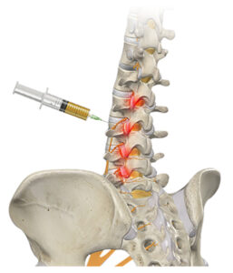 Lumbar Facet Arthritis – Causes, Symptoms & Treatment Options ...