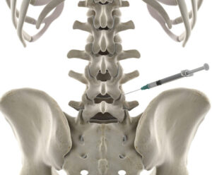 Prolotherapy – The Foundation of Regenerative Medicine - Integrative ...